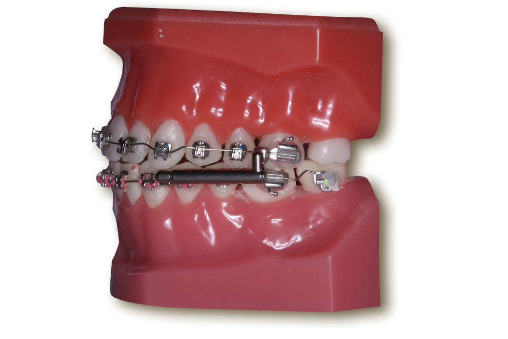 Der Bio Bite Corrector (BBC) führt den Unterkiefer sanft in die ...